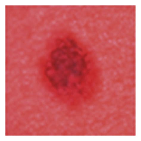 Benign Sample A Input Image B Contrast Limited Histogram