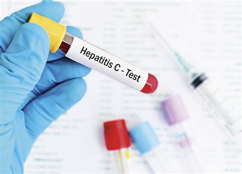 Experts Advise Expanded Hep C Screening Good Times