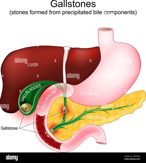 Liver Stone