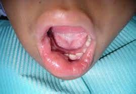 Benjolan Di Bibir Tapi Tidak Sakit Apa Penyebabnya Klinik Gigi SATU Dental
