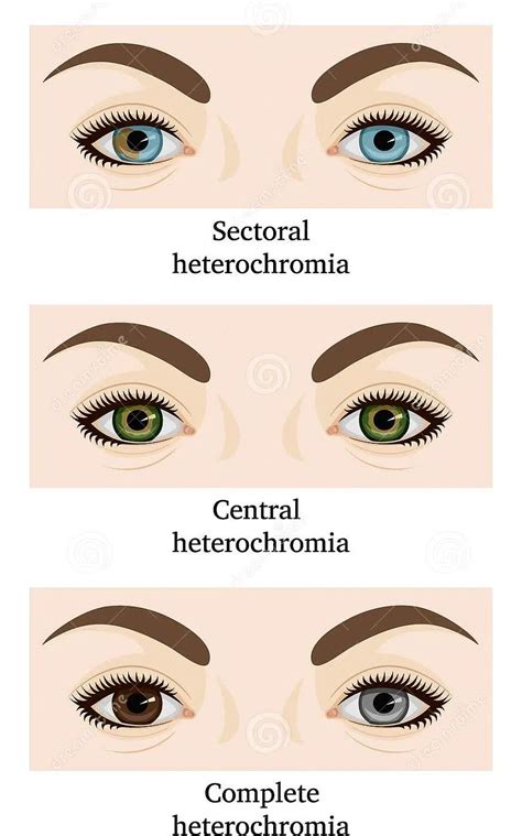 Beroemde Mensen Met Centrale Heterochromie