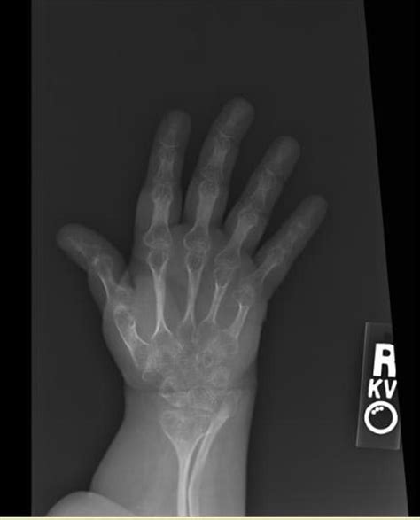 Osteoporosis X Ray Vs Normal Captions Graphic