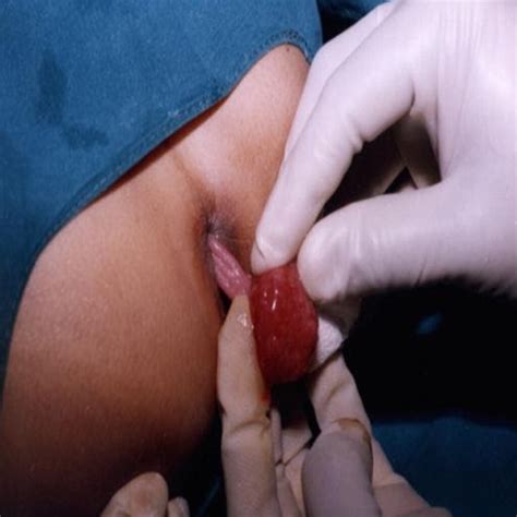 Award Winning Colorectal Polyp Specialist Experienced Colorectal Polyp Surgeon In Indore