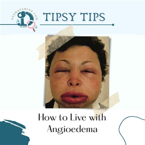 How To Live With Angioedema — Dermapamine By Dermapamine Club