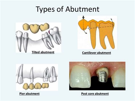 Design Of A Fixed Partial Denture With Abutment Tooth Preparation