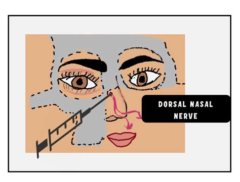 Nerve Blocks For Lacrimal Sac Surgeries A Comprehensive Guide