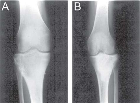 Functional And Radiographic Evaluation Of 214 Aggressive Benign Bone Lesions Treated With