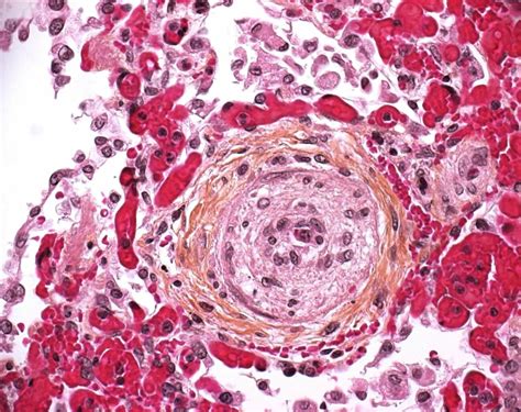 Intimal Fibrosis Human Pathology