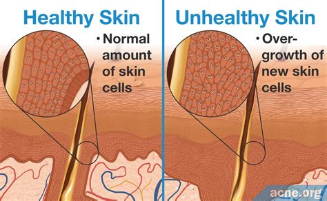 The Role Of Skin Cell Overgrowth Hyperkeratinization In Acne