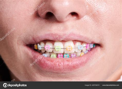 White Bracket Braces