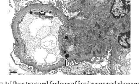 Figure 4 From Collapsing Focal Segmental Glomerulosclerosis In A Patient With Systemic Lupus