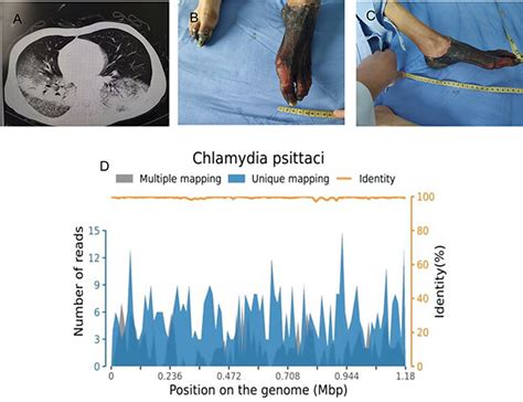 A Chest Computed Tomography Ct Revealed Diffuse Bilateral And