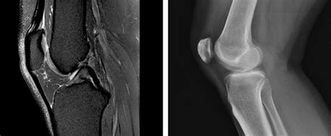 Mri Knee
