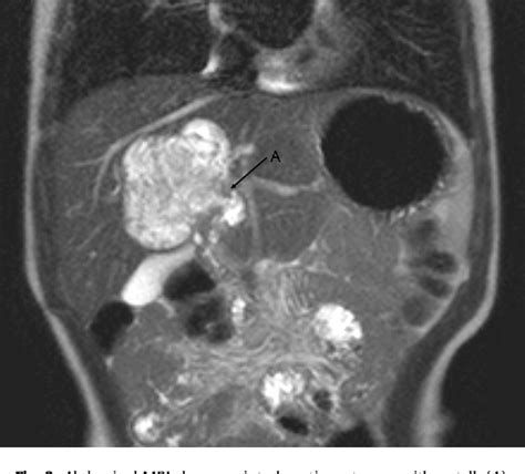 Figure 2 From A Large Intrahepatic Duodenal Duplication Cyst In A 3 Year Old Girl Semantic Scholar