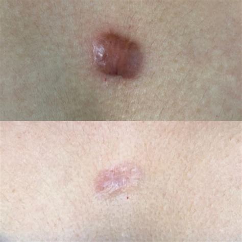 Keloid Skin Tag Removal — Meraki Skin Clinic