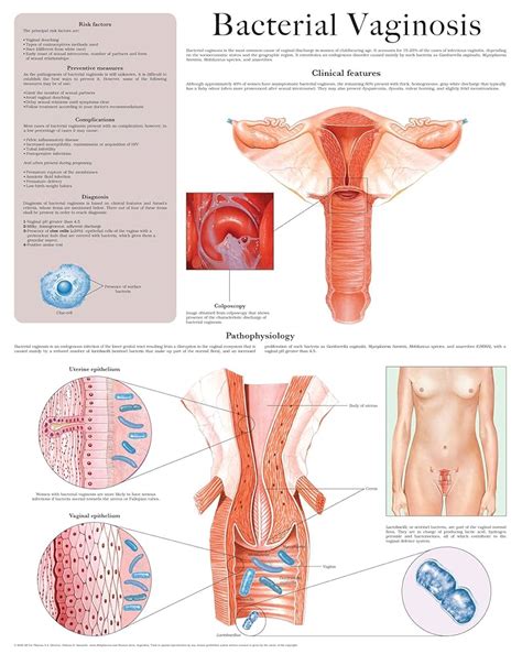 Vaginitis Diagram Uterine Prolapse Physiopedia