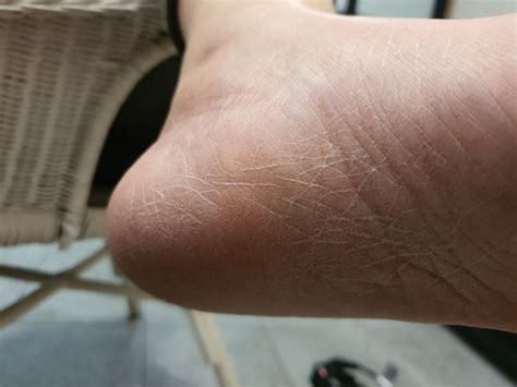 전동 각질제거기 등산 후 발바닥 굳은살 제거 해봤어요 네이버 블로그