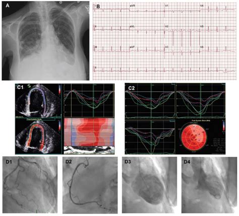 Takotsubo Stress Cardiomyopathy During Treatment With Nivolumab And Download Scientific Diagram