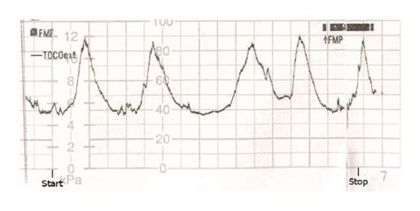 A Uterine Contraction Tracing Obtained By Tocographic Measurement