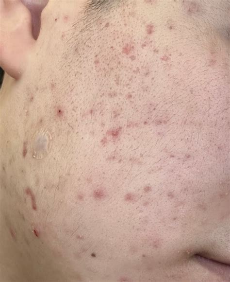 여드름자국 없애는 방법 ㅠㅠㅠ 지식in