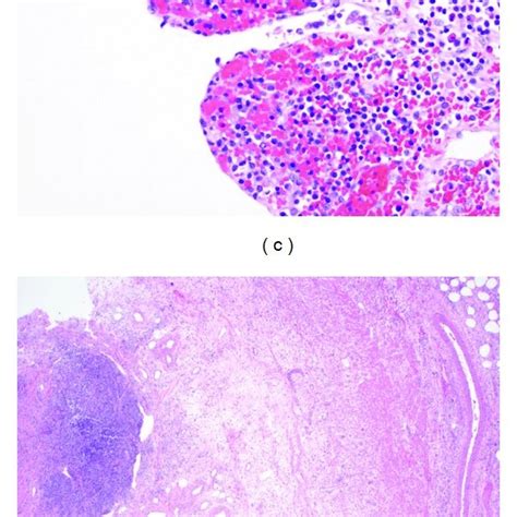 A Cross Section Of Appendix With Disrupted Mucosal Surface And Small