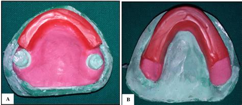 Figure 3 From Cu Sil Denture An Innovative Approach To Preserve The Few Remaining Natural Teeth
