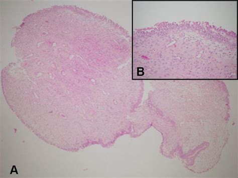 Fibroepithelial Polyp Of Ureter That Has A Loose Fibrovascular Stroma Download Scientific