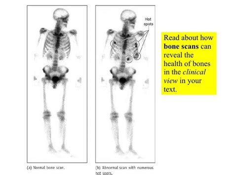 Can A Bone Scan Show Cancer Cancerwalls