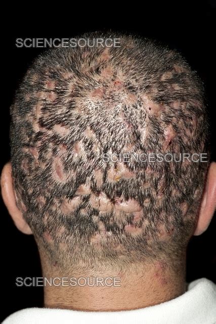 Dissecting Folliculitis On The Scalp Stock Image Science Source Images