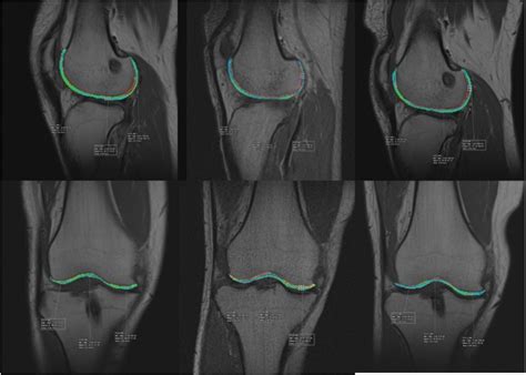 Figure 1 From Single Bundle Vs Double Bundle For Anterior Cruciate Ligament Reconstruction