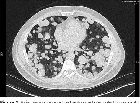 Figure 2 From Curious Case Of Extraskeletal Myxoid Chondrosarcoma Semantic Scholar