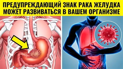 НЕ ПРОПУСТИТЕ 8 РАННИХ ПРИЗНАКОВ РАКА ЖЕЛУДКА ЭТО МОЖЕТ СПАСТИ ВАШУ ЖИЗНЬ Youtube