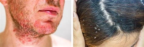 8 Eczema Hair Loss Harleyarrianna