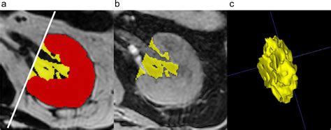 Renal Sinus Fat