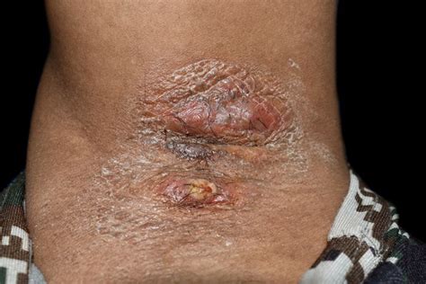 Cellulitis From A Bug Bite Symptoms And Treatment