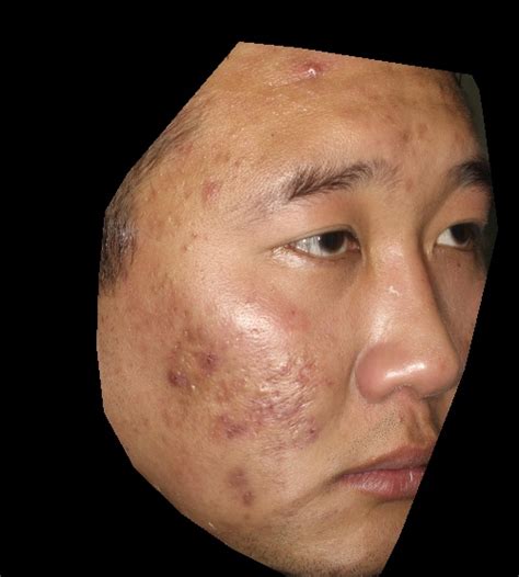 Acne Detection Classification Model By Fractured Detection