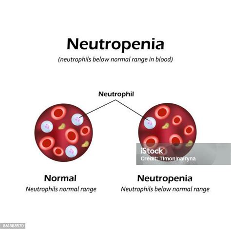 Neutrofil Di Bawah Kisaran Normal Dalam Darah Neutropenia Ilustrasi