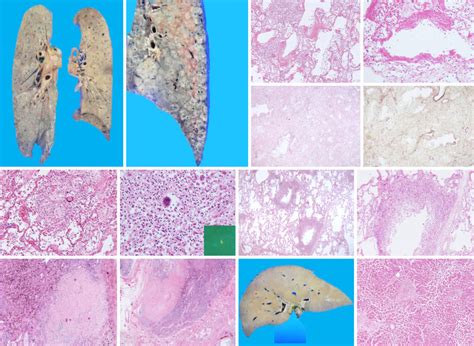 Figure3 Pathological Findings Macroscopically Collapsed Air Space Download Scientific Diagram