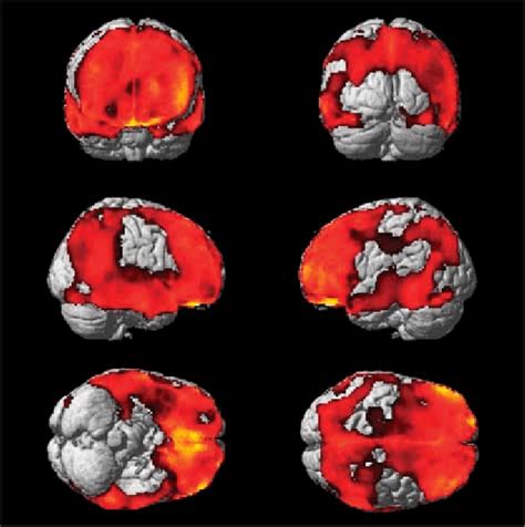 Visualization Of The Results Of Statistical Parametric Mapping Download Scientific Diagram
