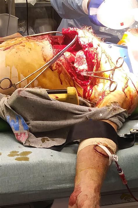 Mva With Ejection — Clamshell Thoracotomy Rems