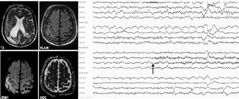 67 Year Old Male Patient With Post Stroke Epilepsy Hospitalized With Download Scientific