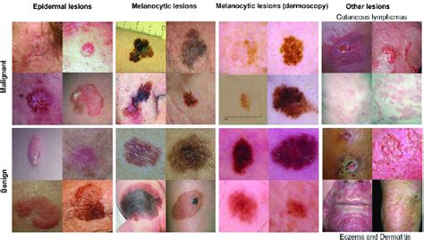 Example Images From The Dataset Both Photographic And Dermoscopic Download Scientific Diagram
