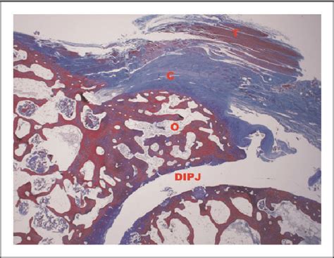 Figure 2 From The Anatomy Of The Extensor Tendon Insertion In The Arthritic Distal
