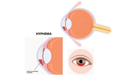 Traumatic Hyphema
