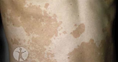 Pityriasis Versicolor Image