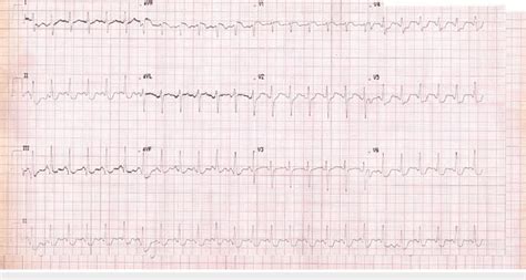 Post Icu Transfer First Ecg After Hemodynamic Deterioration Showing