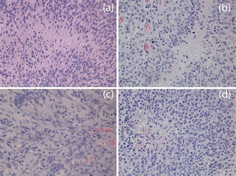 High Grade Brainstem And Cortex Glioma Induced With Identical Genetic