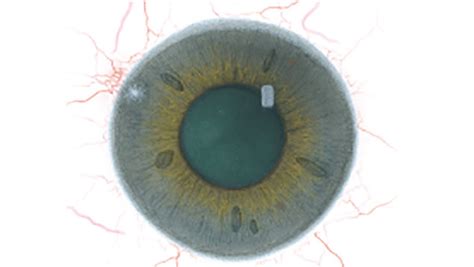 Efron Grading Scales Coopervision Australia