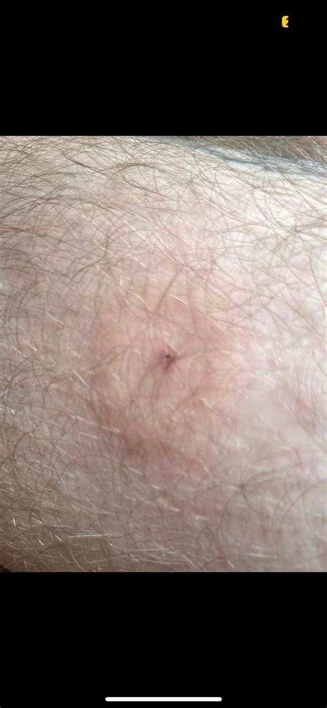 Could These Be Tick Bites R Ukhiking