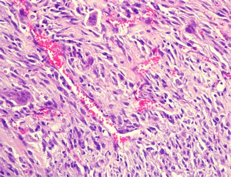 Fibroblastic Pattern With Activation Of Osteoclastic Activity And Download Scientific Diagram